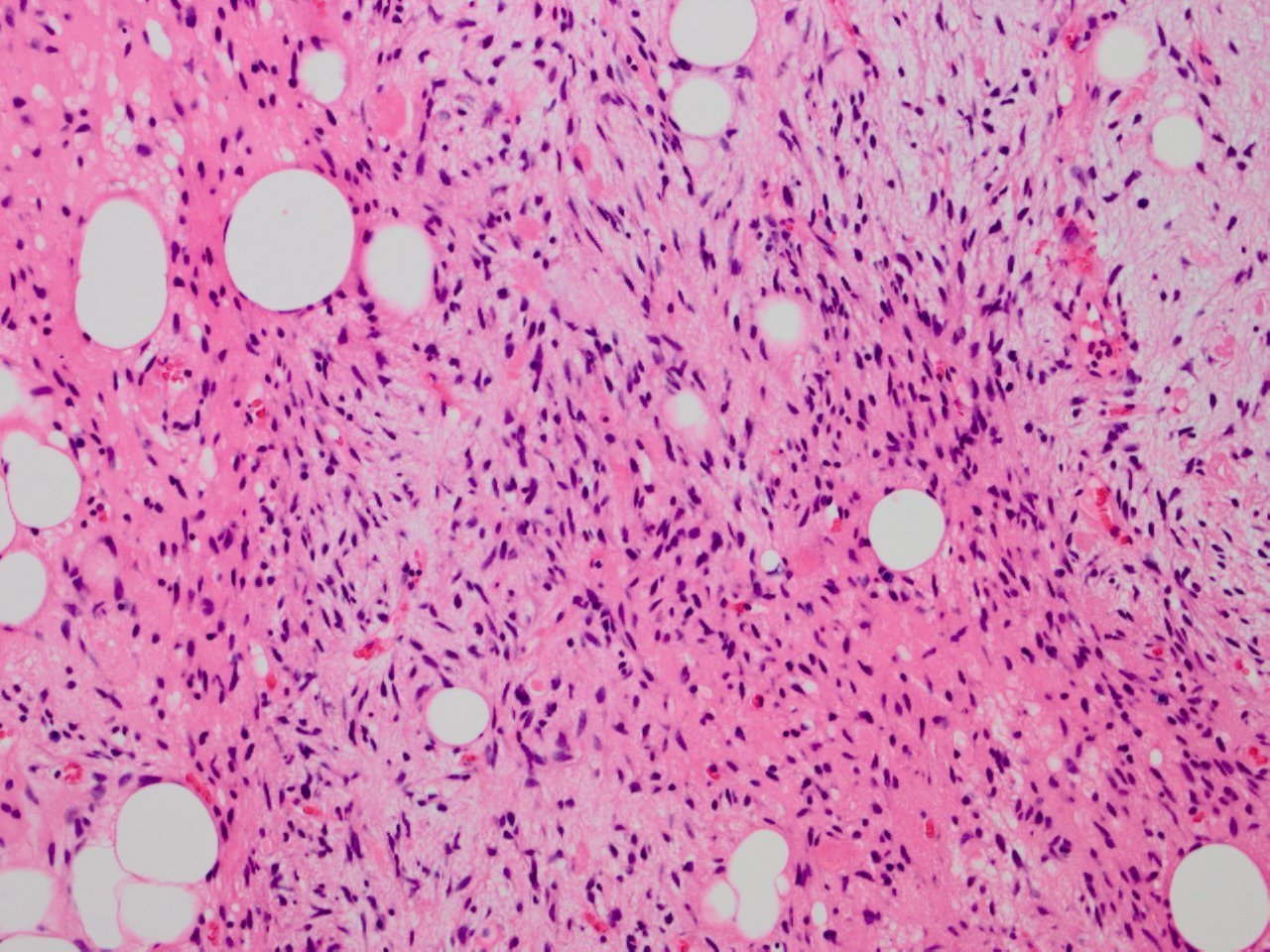 Atypical spindle cell lipoma 異型紡錘形細胞脂肪腫: 軟部腫瘍病理の部屋