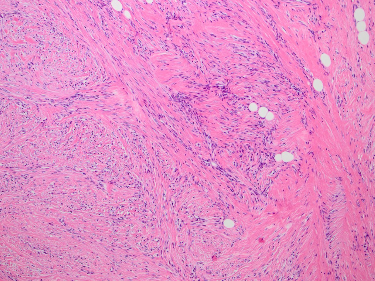 Atypical spindle cell lipomatous tumor 異型紡錘形細胞脂肪腫様腫瘍: 軟部腫瘍病理の部屋