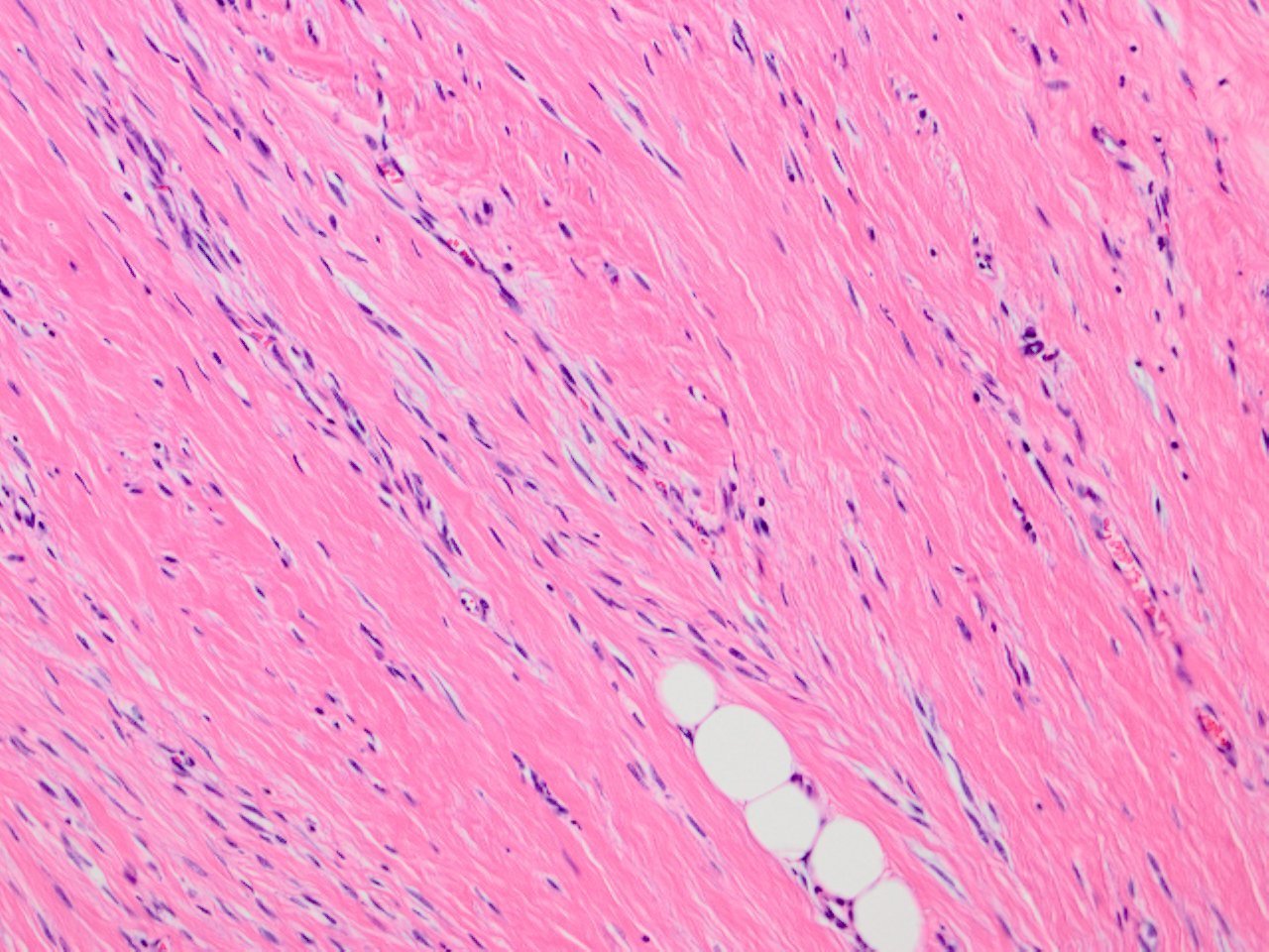 Atypical spindle cell lipomatous tumor 異型紡錘形細胞脂肪腫様腫瘍: 軟部腫瘍病理の部屋