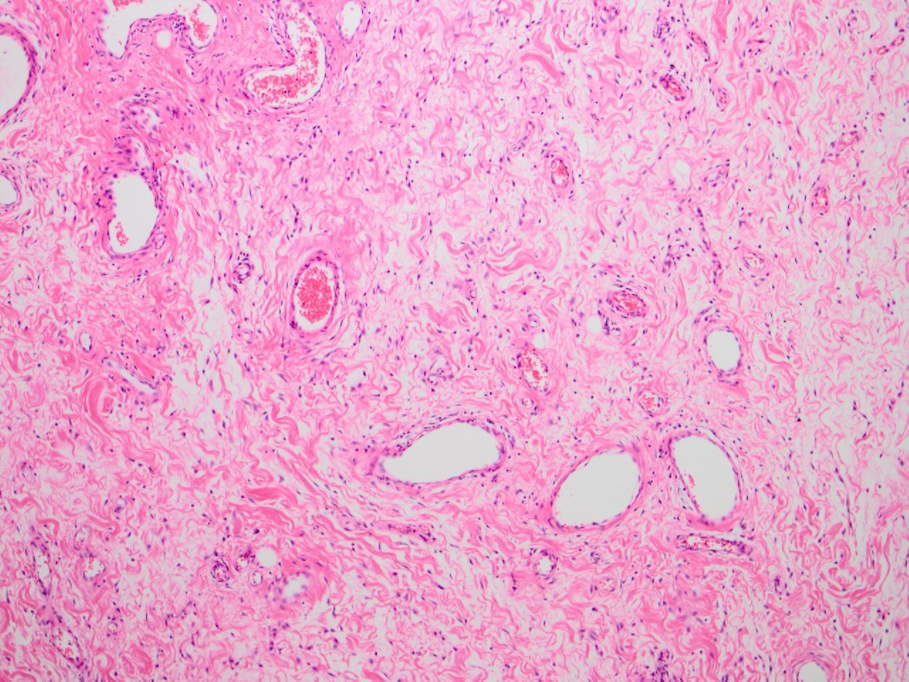 Aggressive angiomyxoma 侵襲性血管粘液腫: 軟部腫瘍病理の部屋