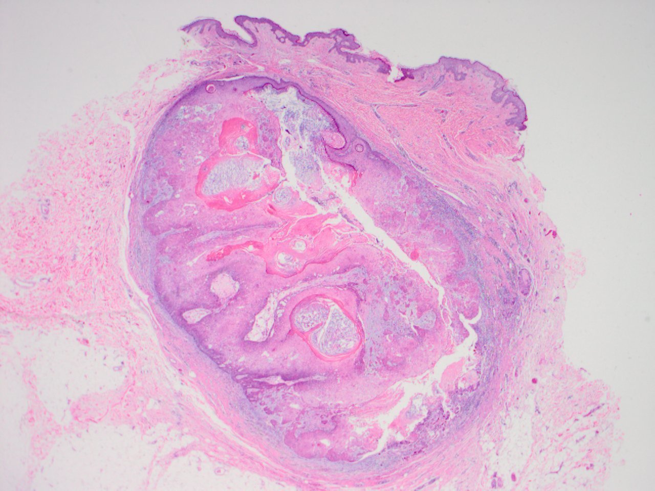 Proliferating epidermal cyst 増殖性表皮嚢胞: 軟部腫瘍病理の部屋
