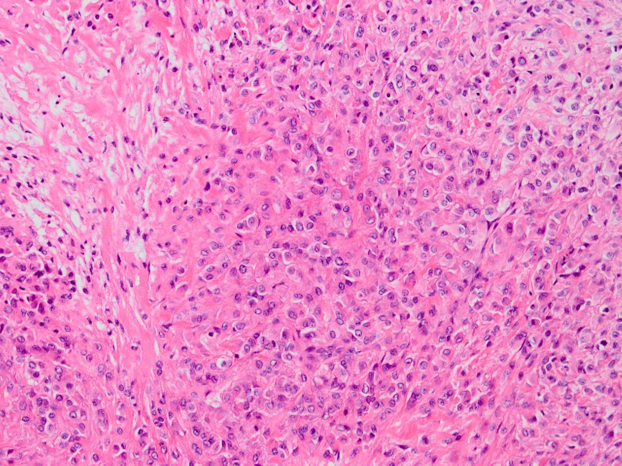 Epithelioid sarcoma, distal (classical/conventional) type 遠位型（古典的/通常型）類 ...
