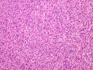 Low-grade malignant peripheral nerve sheath tumor (MPNST) 低悪性度悪性末梢神経鞘腫瘍 ...