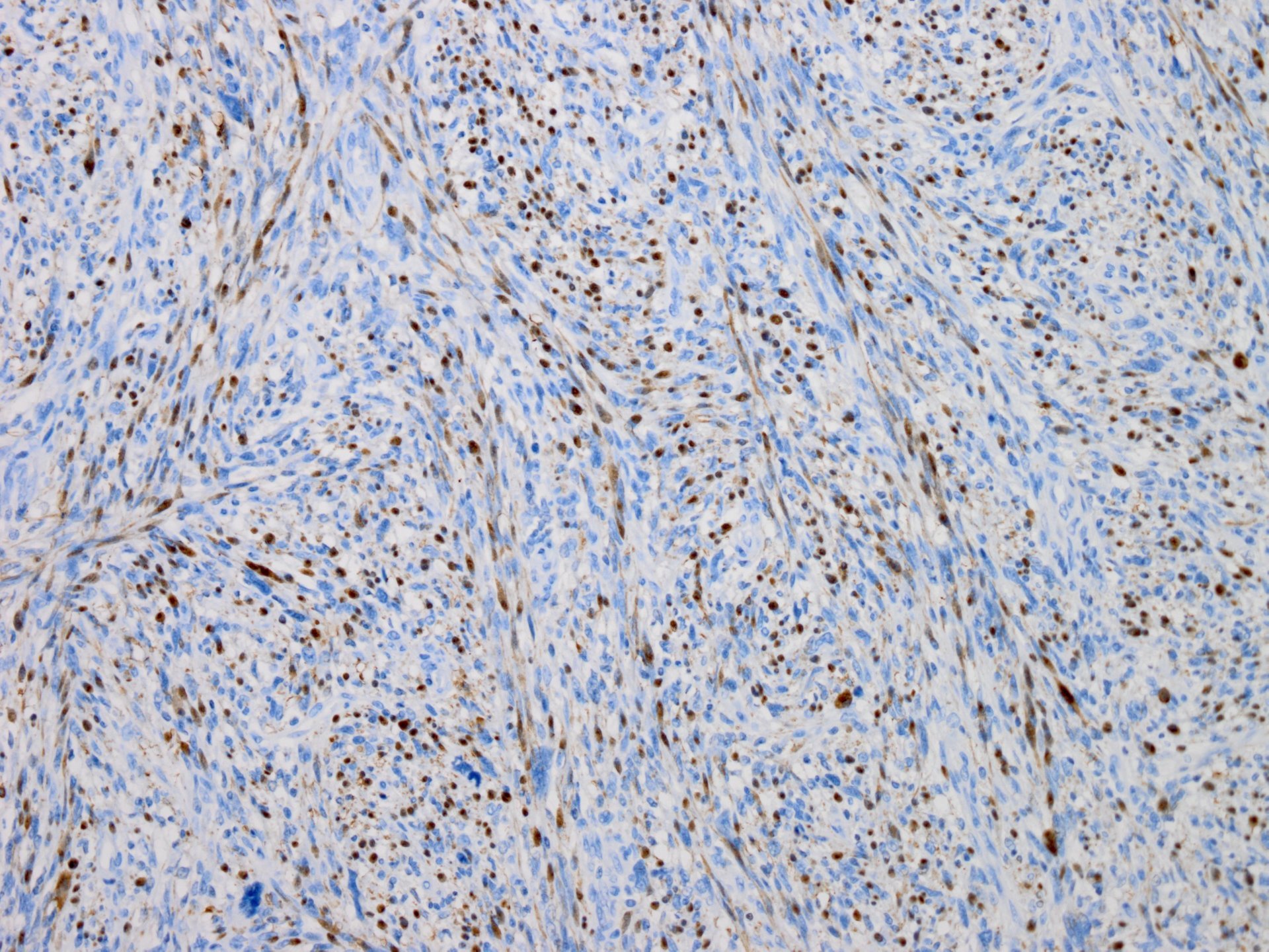 Low-grade malignant peripheral nerve sheath tumor (MPNST) 低悪性度悪性末梢神経鞘腫瘍 ...