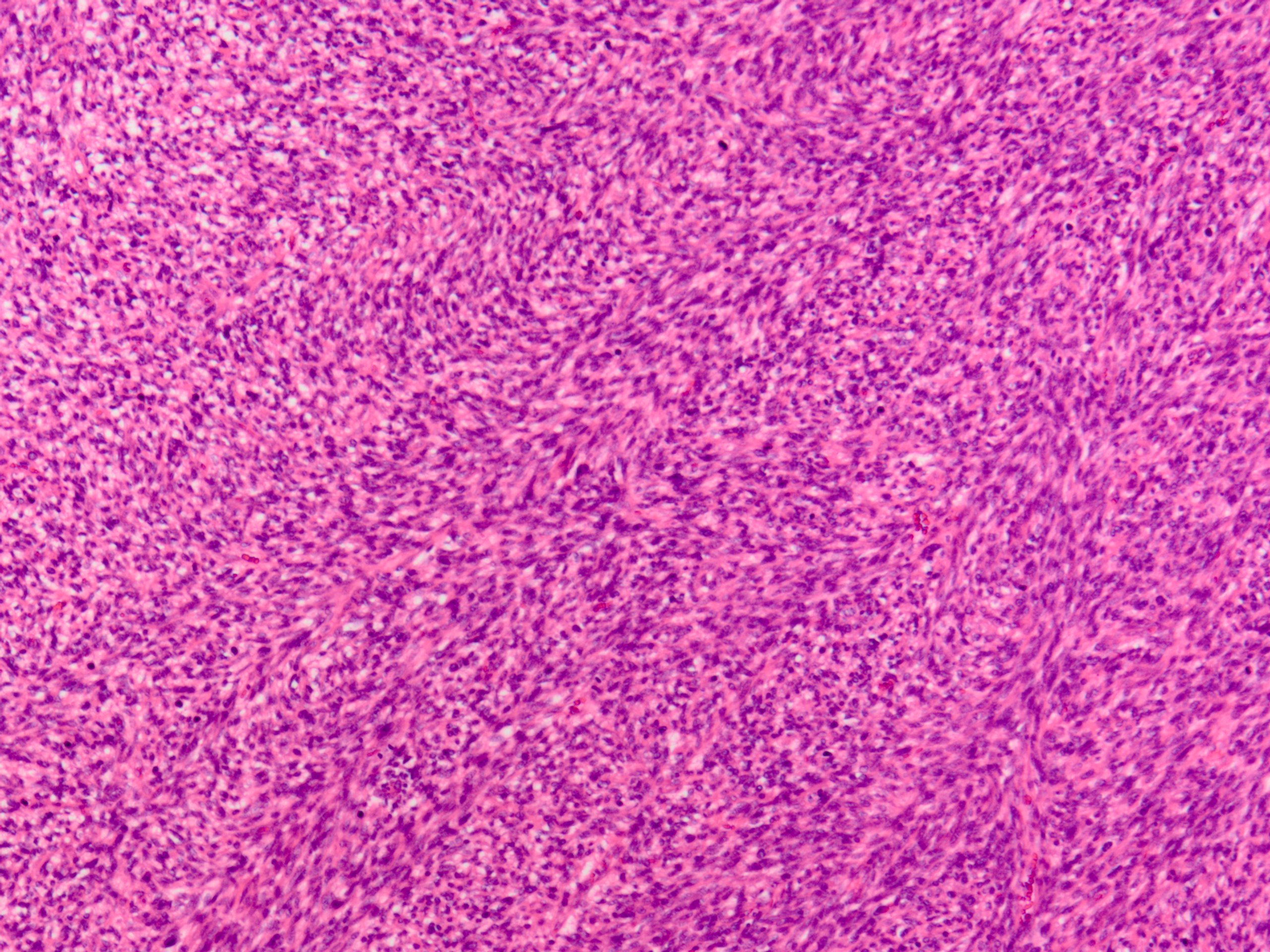Dermatofibrosarcoma protuberans DFSP (recurrence) 隆起性皮膚線維肉腫（再発例）: 軟部腫瘍病理の部屋