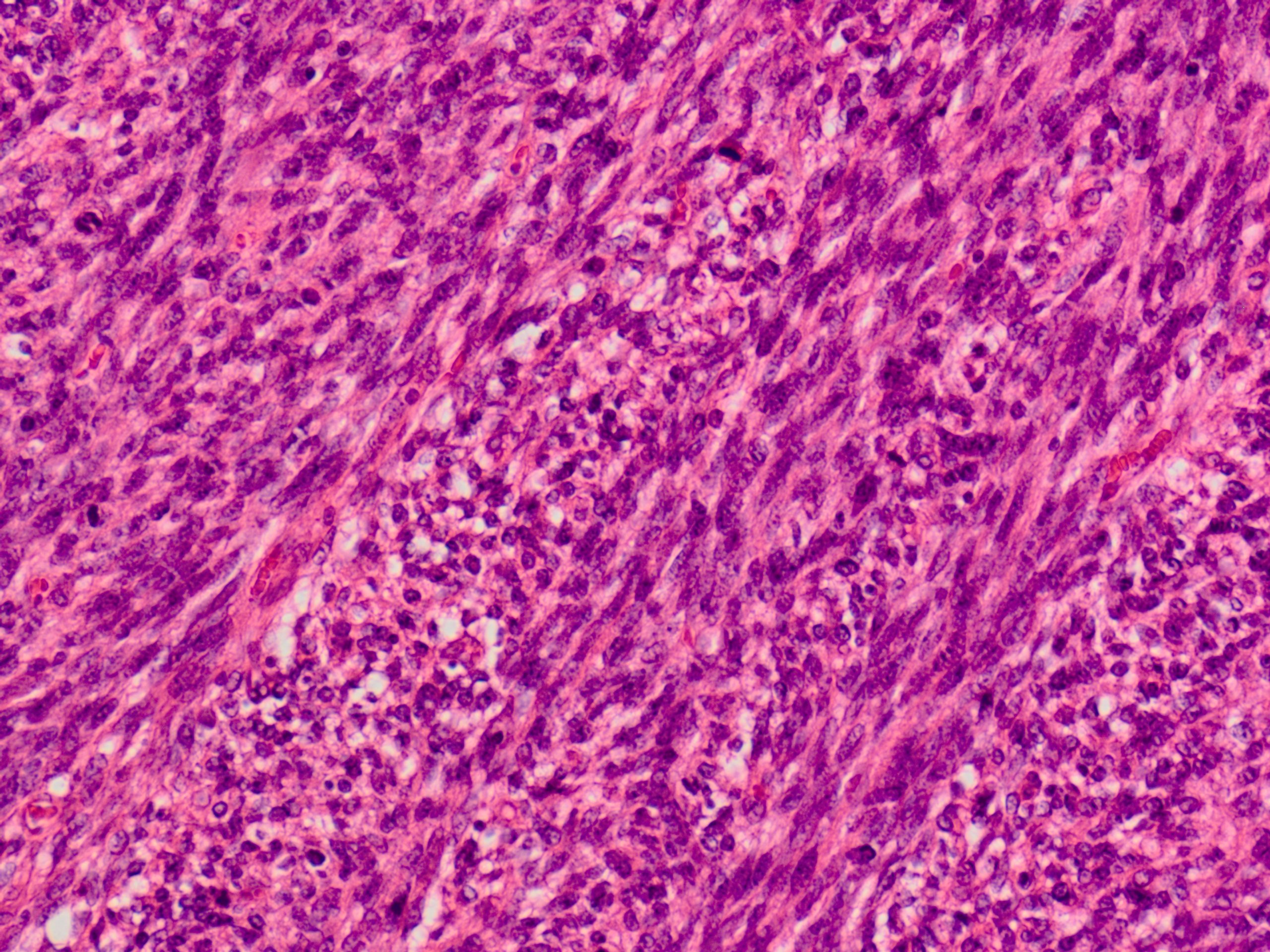 Dermatofibrosarcoma protuberans DFSP (recurrence) 隆起性皮膚線維肉腫（再発例）: 軟部腫瘍病理の部屋