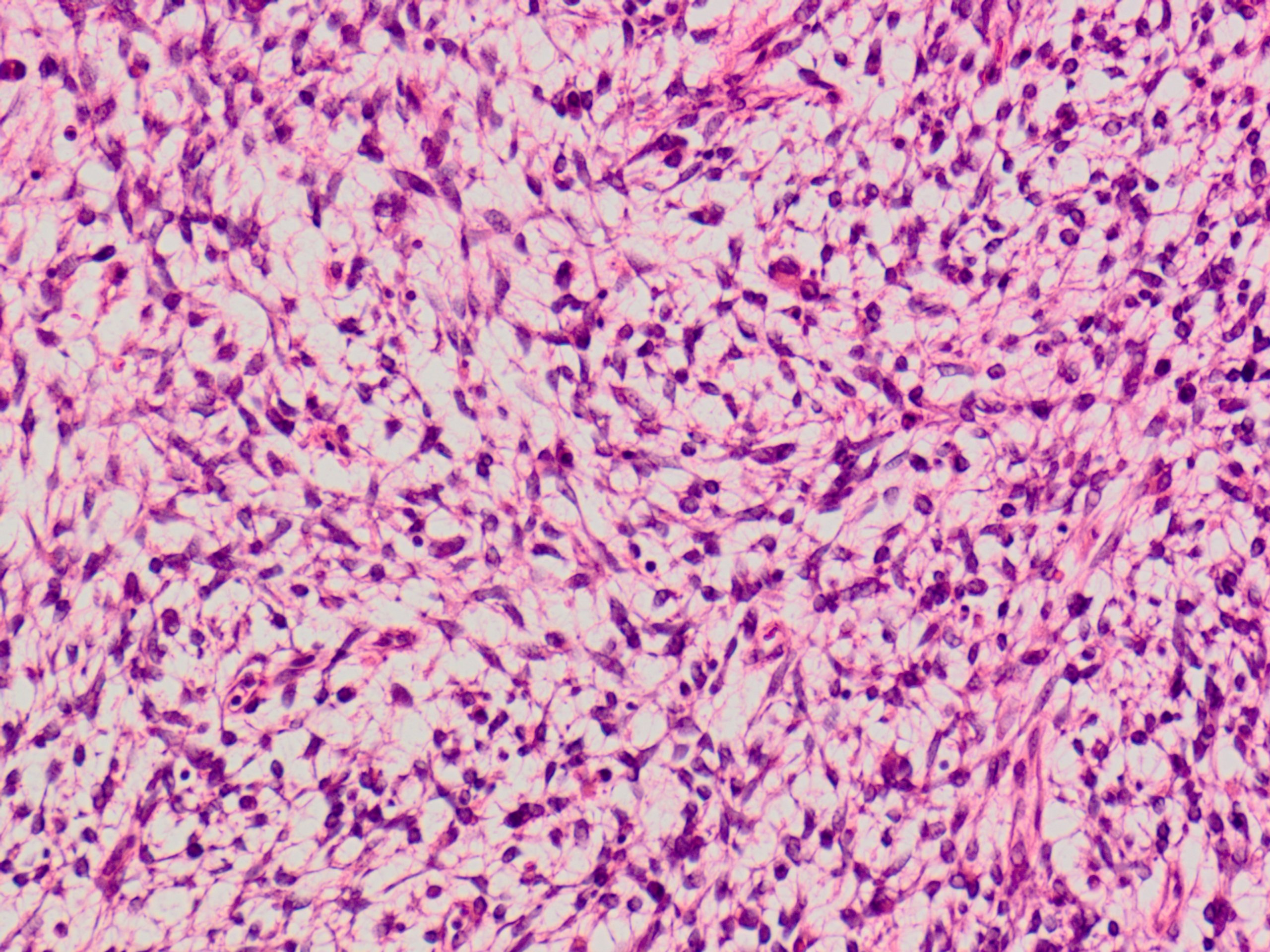 Dermatofibrosarcoma protuberans DFSP (recurrence) 隆起性皮膚線維肉腫（再発例）: 軟部腫瘍病理の部屋