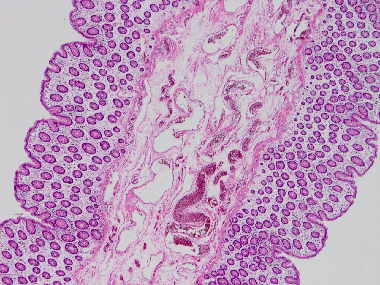 Colonic muco-submucosal elongated polyp (CMSEP): 軟部腫瘍病理の部屋