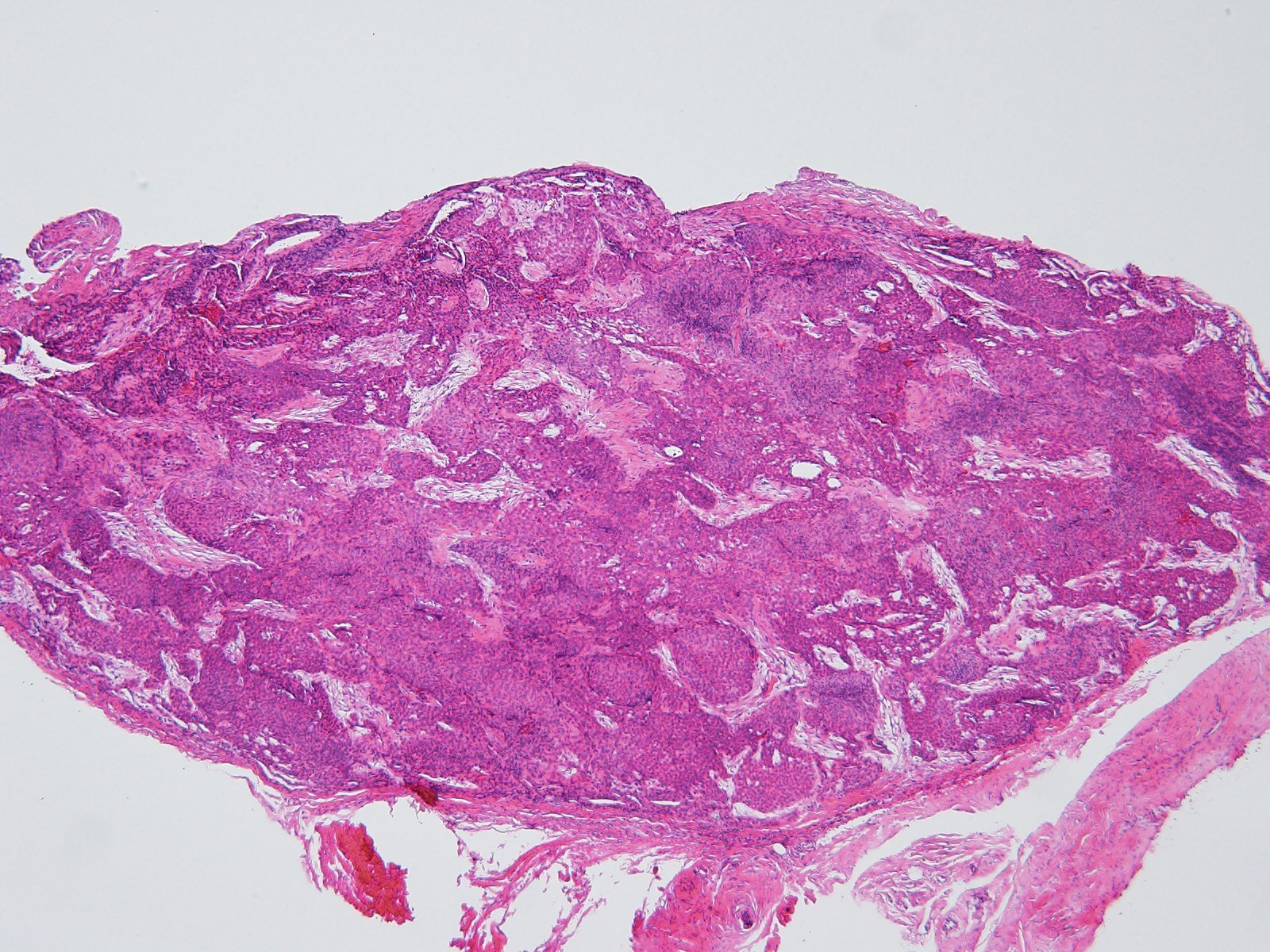 Glomus tumor グロームス腫瘍: 軟部腫瘍病理の部屋
