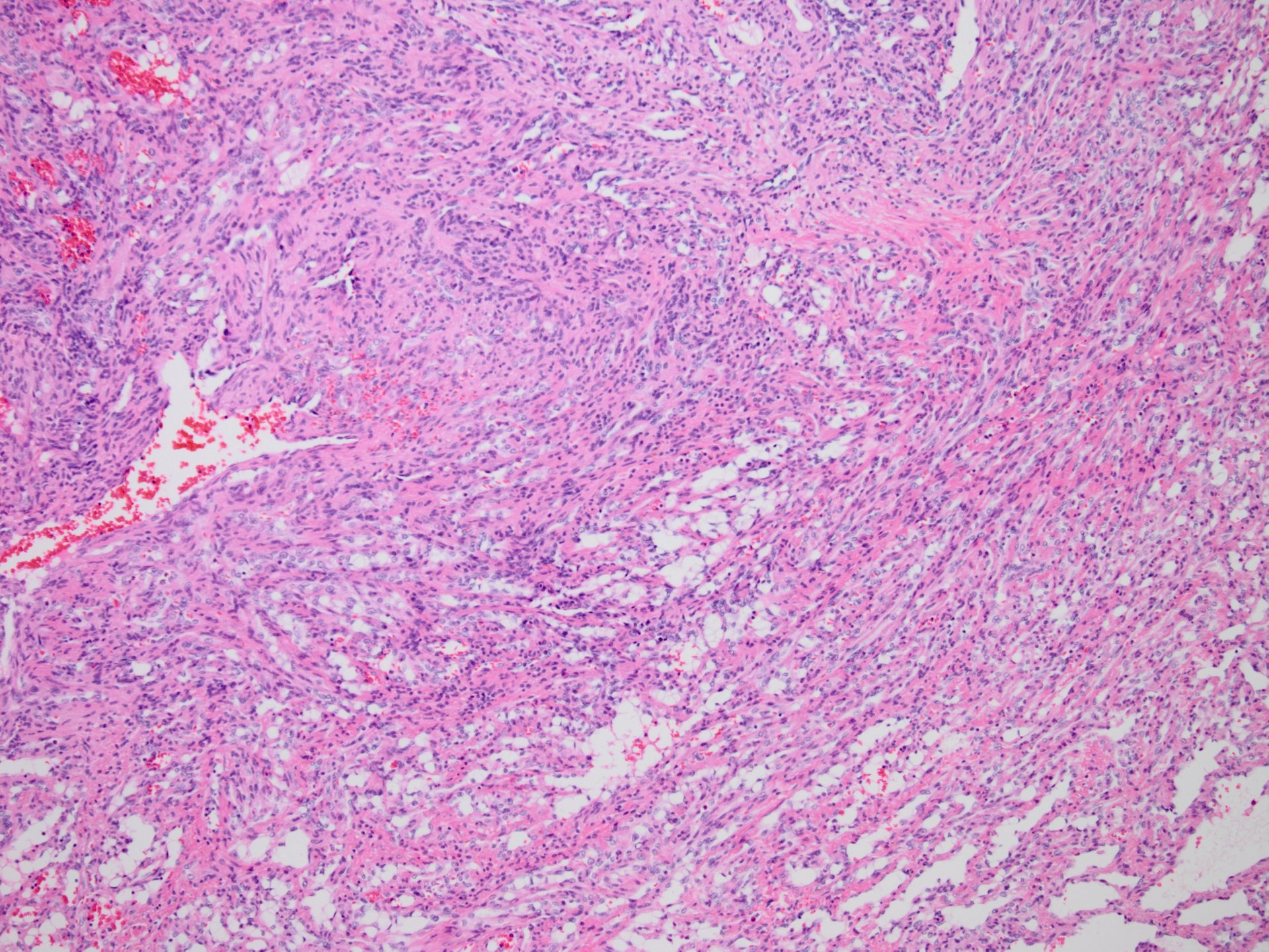 Spindle cell hemangioma 紡錘形細胞血管腫: 軟部腫瘍病理の部屋